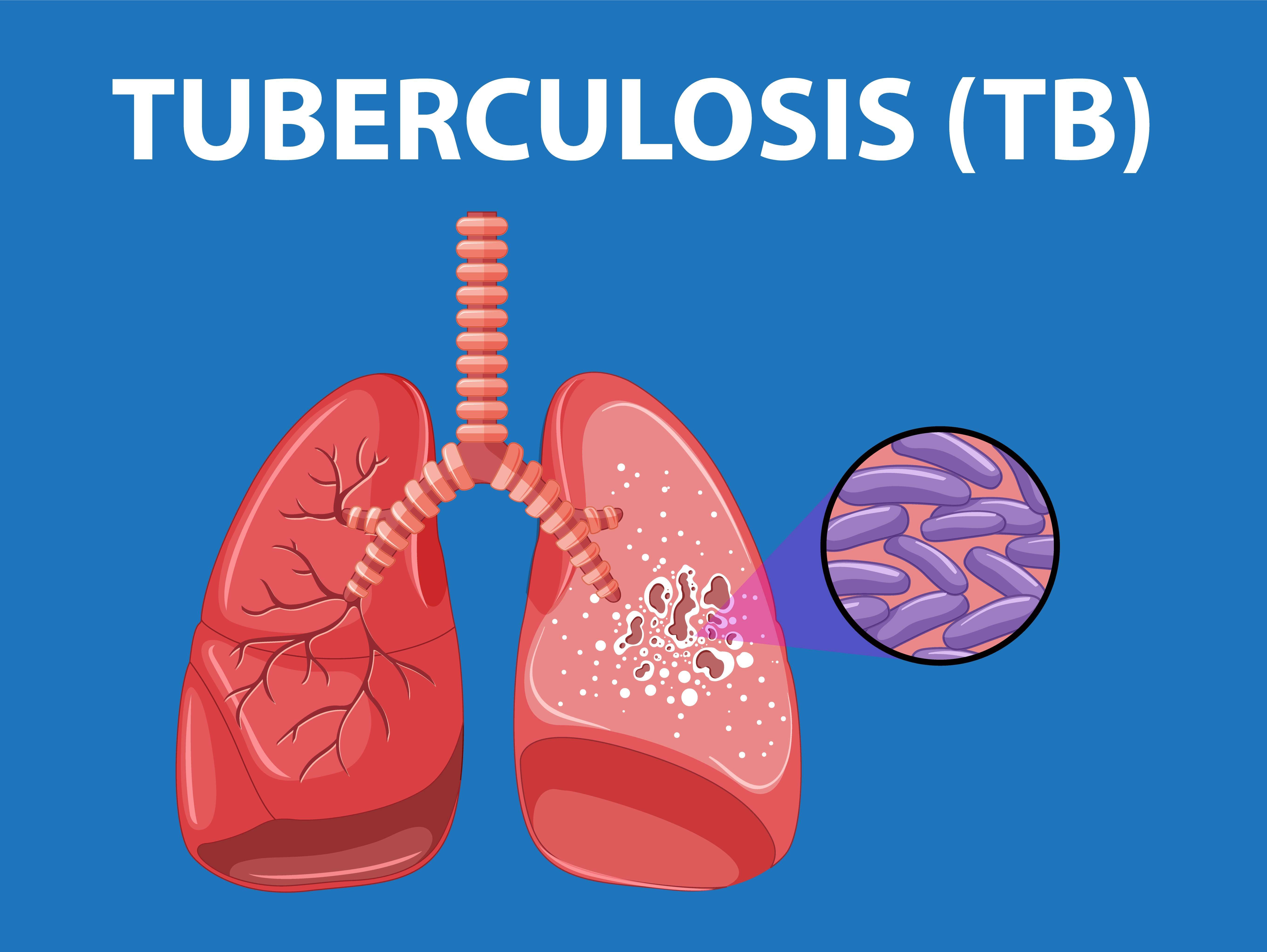 Indonesia Hadapi Ancaman Serius Akibat Kasus Tuberkulosis Meningkat ...